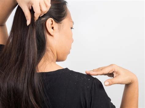 Yuk Atasi Masalah Rambut Berketombe Dengan Mulai Dari Perawatan Scalp