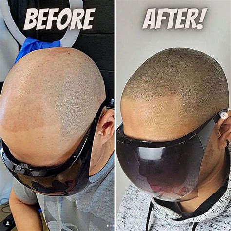 Scalp Micropigmentation Results Gallery Enhanced Scalp Scalp Micropigmentation Results Gallery Enhanced Scalp