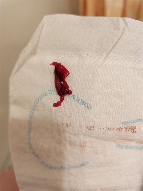 Vruchtzakje Miskraam 6 Weken Zwangerschap En Geboorte