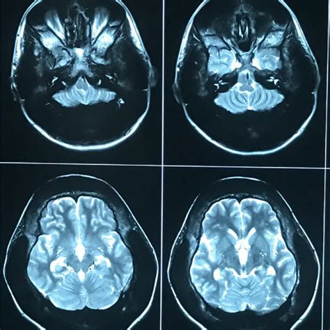 Ct Scan Of The Skull Showing Diffuse Skull Bone Thickening Download Scientific Diagram