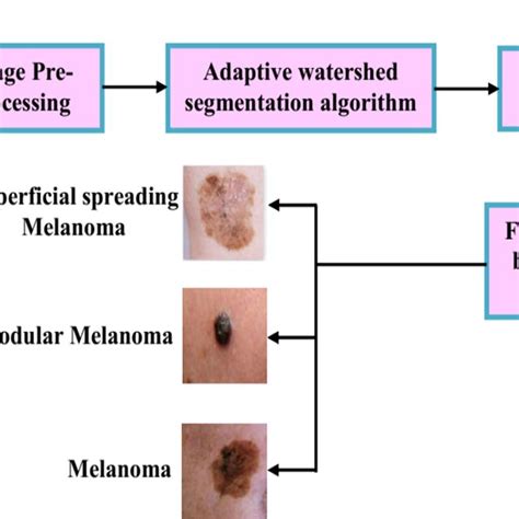 Melanoma Classification Performance Using Fractal Neural Network Based