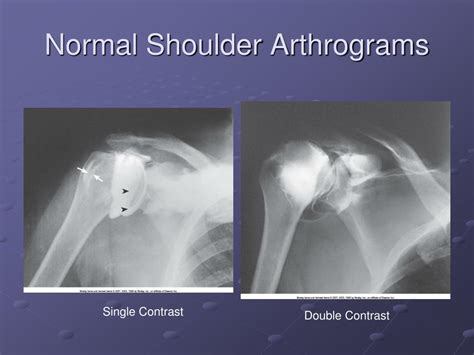 Ppt Arthrography Powerpoint Presentation Free Download Id 443478