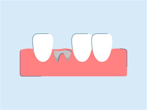 Dry Socket Vs Normal Socket After Tooth Extraction
