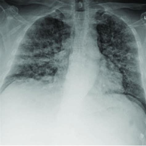 Anterior Posterior Chest X Ray Showing Extensive Bilateral Nodular