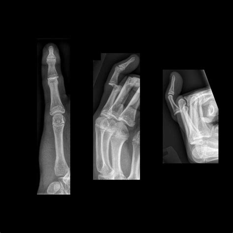 Pediatric Phalanx Fracture In The Hand Pediatric Radiology Reference