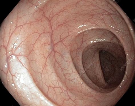 Normal Colon Endoscopy