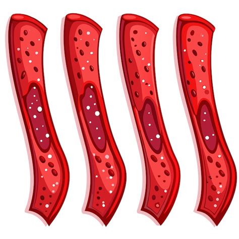 Blood Clot Diagram On A Isolated White Background 14 Premium Ai