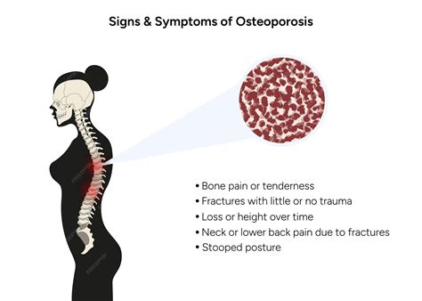 Premium Vector Signs And Symptoms Of Osteoporosis In Vector