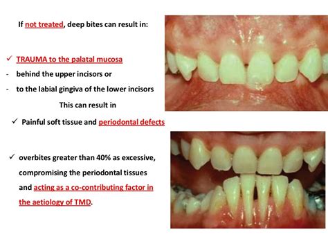 Management Of Deep Bite Dr Nabil Al Zubair