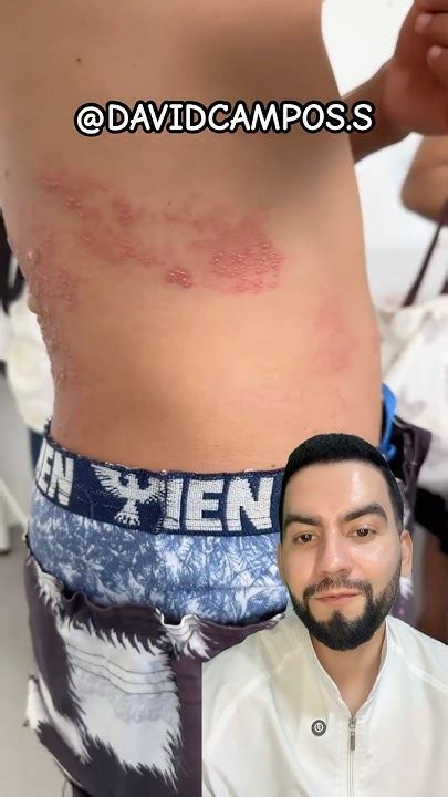 AsÍ Se Ve La Culebrilla Youtube