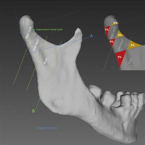 Classification Of Condylar Morphology In Coronal Section By Yale Et Al