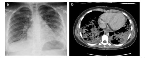 Left Basilar Airspace Disease Captions Cute Viral