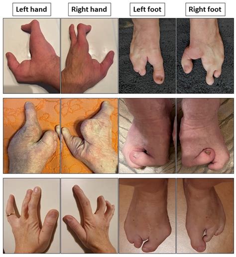 Ectodermal Dysplasia Hands