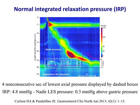 Normal And Abnormal Swallows In Chicago Classification Version 30 Ppt