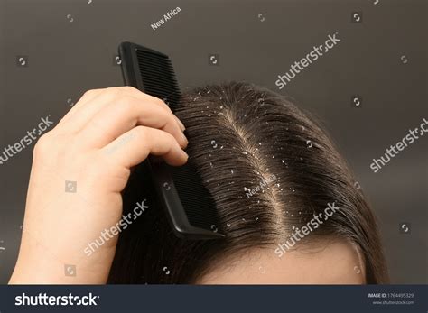 Removing Dandruff Images Stock Photos Vectors Shutterstock