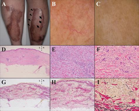 Jle European Journal Of Dermatology A Case Of Annular Elastolytic