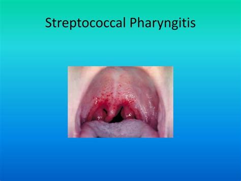 Acute Rheumatic Feverpptx