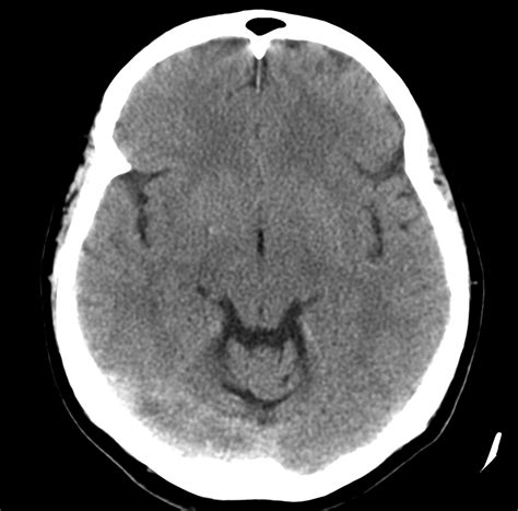Subarachnoid Hemorrhage Due To Intradural Cerebral Aneurysm And