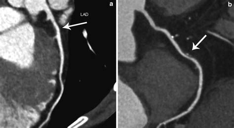 CT Angiography State Of The Art Radiology Key