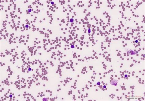 Marginal Zone Lymphoma LearnHaem Haematology Made Simple