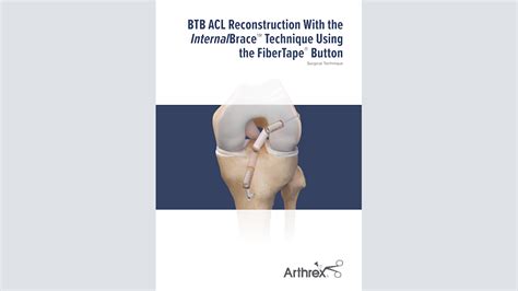 Arthrex Btb Autograft Acl Reconstruction