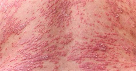 D Vitamin Nedkæmper Autoimmune Sygdomme Illviddk