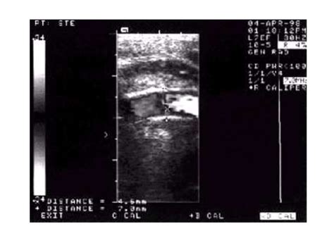 Ультразвуковое исследование сосудов презентация онлайн