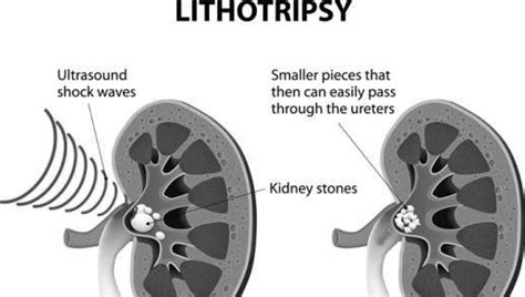 Lithotripsy