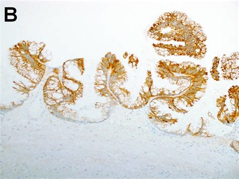 Neoplastic Cells Of Borderline Mucinous Tumour Of The Renal Pelvis