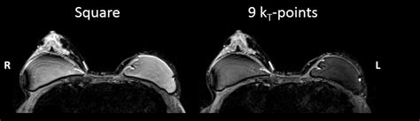 Figure Acquisition Example Year Old Patient With Left Mastectomy