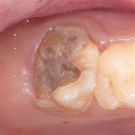 Zerodonto Complex Rehabilitation In Prosthodontics By Dr Mauro