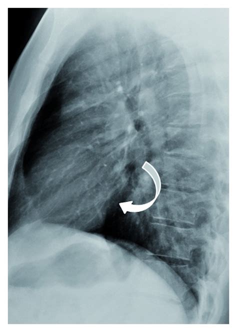 A Frontal Radiograph Shows The Presence Of A Hemispheric