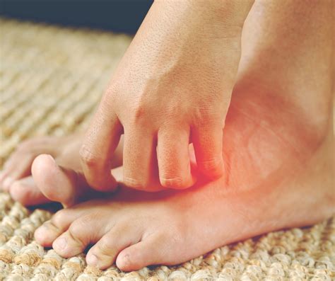 Common Foot Fungal Infections Causes Symptoms And Prevention My