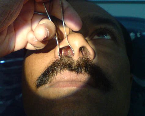 Nasal Polyps Canada Pdf Ppt Case Reports Symptoms Treatment