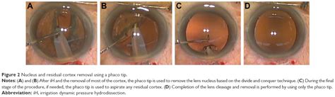 Use Of The Phaco Tip Technique For Lens Cleavage And Removal During Ca Opth