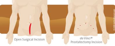 Prostate Cancer Surgery Tuscaloosa Al West Alabama Urology Associates