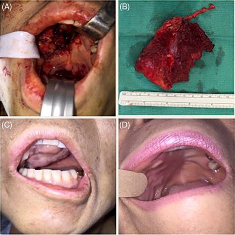 Patient Status‐postpartial Maxillectomy For Palatal Hemangioma