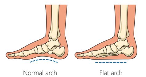 Signs Of Flatfeet What You Need To Know