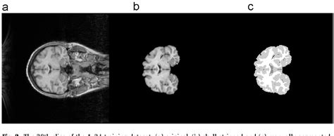 Figure 2 From Combining Stationary Wavelet Transform And Self Organizing Maps For Brain Mr Image
