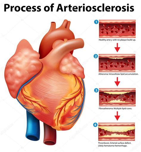 Arteriosclerosis Causes Symptoms Treatment Patient9