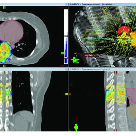 Isodose Distribution For Three Dimensional Conformal Radiation