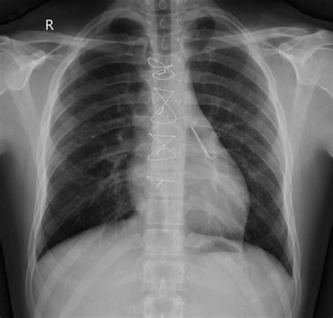 Left Atrial Appendage Closure Device Atriclip Pacs