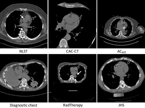 What Does A Ct Heart Scan Look Like