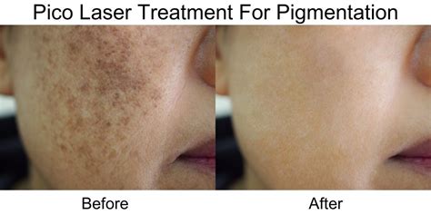 Pico Laser Malaysia Effective Fast Safe And Best Price