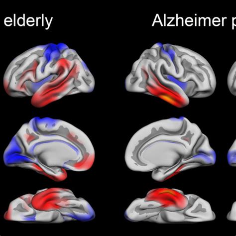Pdf One Year Brain Atrophy Evident In Healthy Aging