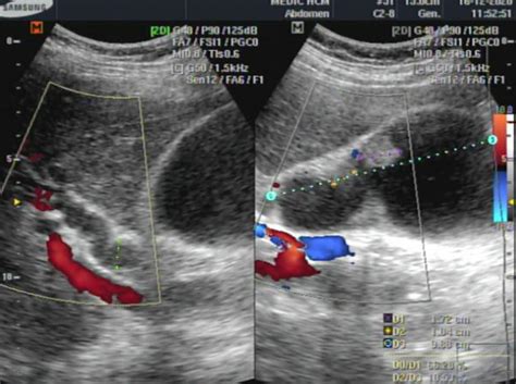 Vietnamese Medic Ultrasound Case 606 Extrahepatic Multiple