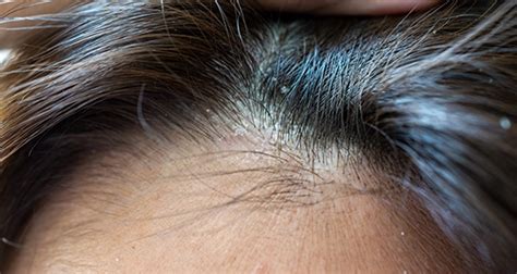 Scalp Peeling Cost Near Me In Sunny Isles