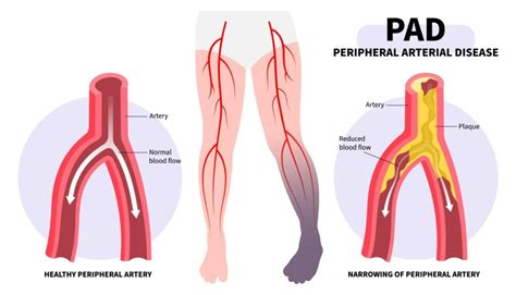 Angioplasty Vs Atherectomy American Endovascular
