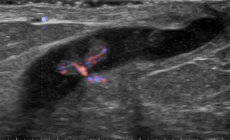 Breast And Axilla 5 1 Benign Lesions Case 5 1 10 Ductal Lesions Ultrasound Cases