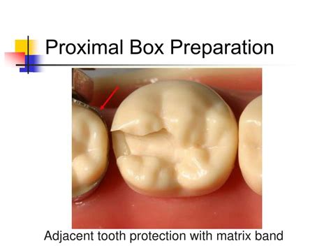 Ppt Class Ii Restorations Powerpoint Presentation Free Download Id
